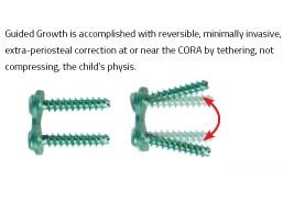 Corpomedica Sistema De Crecimiento Guiado Eight Plate Quad Plate