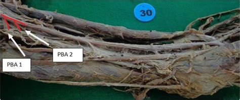 Figure 2 From A Study Of Variations In Brachial Artery And Its