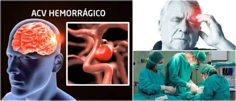 ACV Hemorrágico Qué es Causas Factores de Riesgo Síntomas
