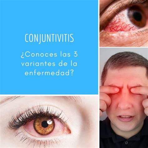 Conjuntivitis Tipos Y Causas The Best Porn Website