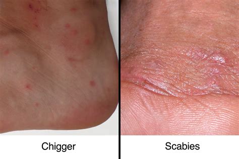 Itchy Bumps On Skin Like Mosquito Bites Sea Lice That Nasty Rash You