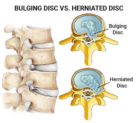 Dedicated Proficient Bulging Disc Doctor Near Plainfield NJ