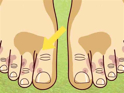 Cómo evitar los hongos en los pies y dile adiós a las infecciones fúngicas