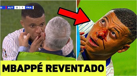 Mbapp Se Rompe La Nariz En Francia Austria Uefa Euro