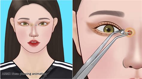 Asmr Remove Severely Infected Nose Piercing Pus Squeeze Nose Acne
