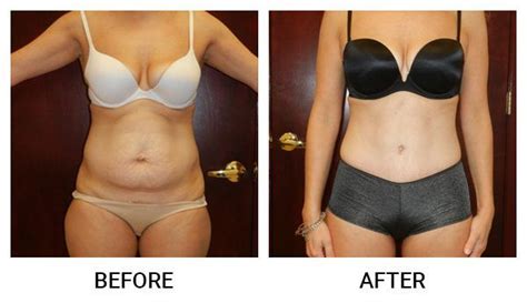 Abdominoplasty Hernia Repair And Liposuction Babylon NY Samara