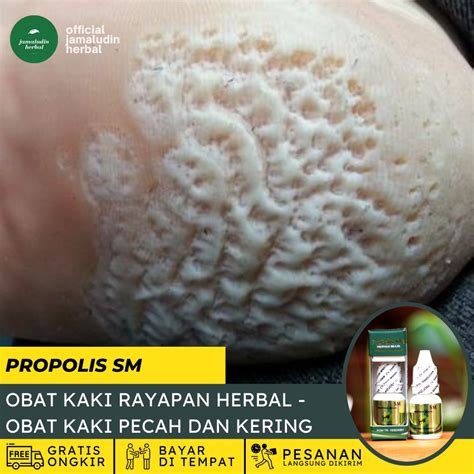 Jual Obat Kaki Rayapan Herbal Obat Kaki Pecah Dan Kering Obat Kaki