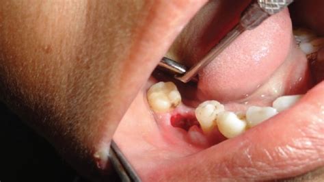 Dry Socket Symptoms Causes Treatment And Prevention