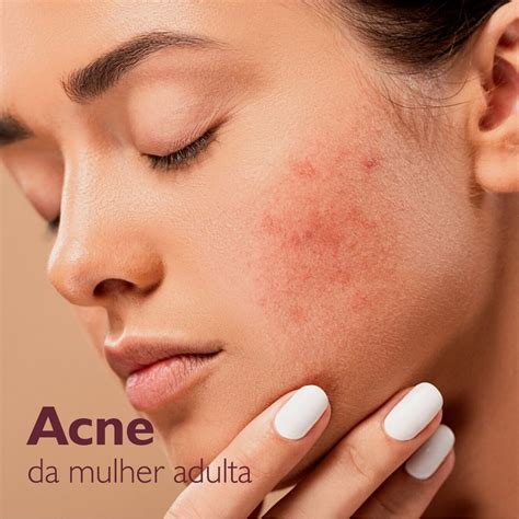 Acne Da Mulher Adulta Cepelle Dermatologia Curitiba