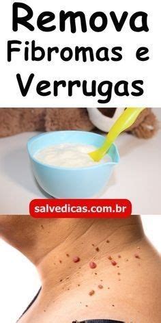 Remedios Naturales Para Eliminar Las Verrugas De Tu Cuerpo Artofit