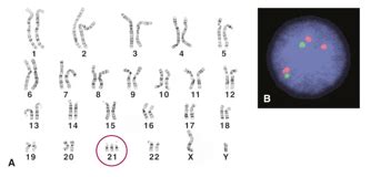 Chromosomal Abnormalities Flashcards Quizlet