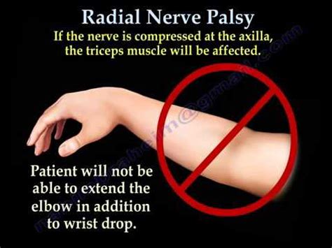 Radial Nerve Palsy Injury Wrist Drop Youtube