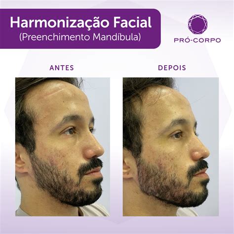 Harmonização Facial Harmoniza e rejuvenesce o seu rosto Pró Corpo