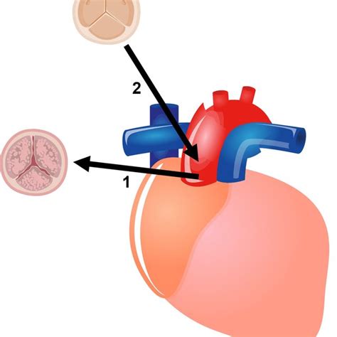 Schematic Representation Of A Biological Surgical Aortic Valve