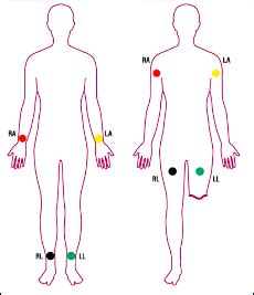 Lead Ecg Flashcards Quizlet
