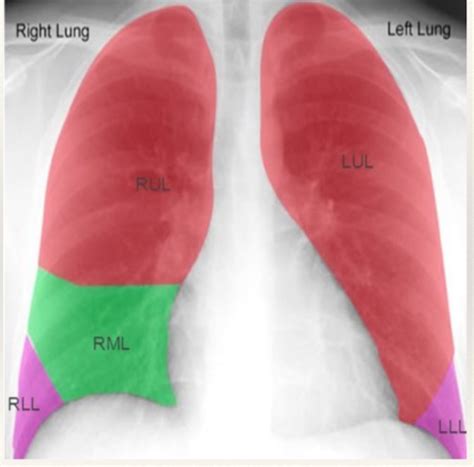 Chest X Ray Flashcards Quizlet