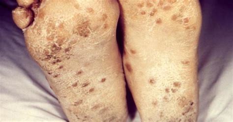 Syphilis Rash On Feet