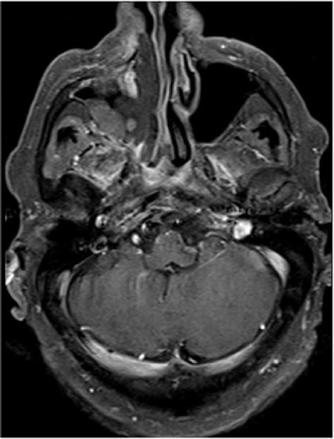 A Axial Post Contrast Fat Saturated T1 Weighted MRI Showing Complete