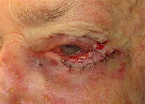 Rbcp Reconstruction Of The Lower Eyelid Using A Full Thickness Upper