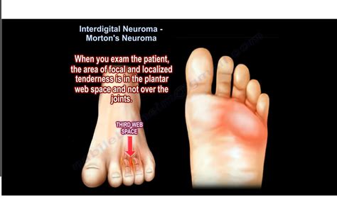 Mortons Interdigitial Neuroma Orthopaedicprinciples