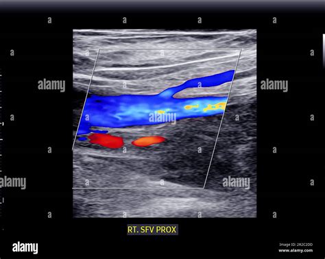 Détermination par échographie Doppler couleur chez les patients