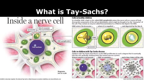 Tay Sachs Disease PPT