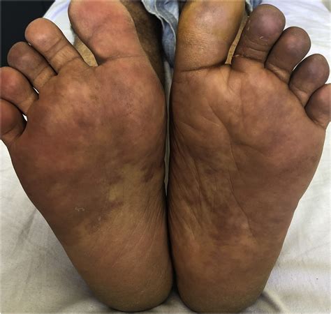 Burning Red Hot Feet European Journal Of Internal Medicine