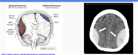 Traumatic Brain Injury Flashcards Quizlet