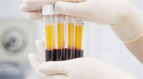 Plasma rico en plaquetas VS terapia de células madre Quién es malo