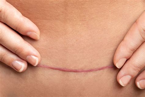 C Section Recovery Mobility Eating Incision Pain