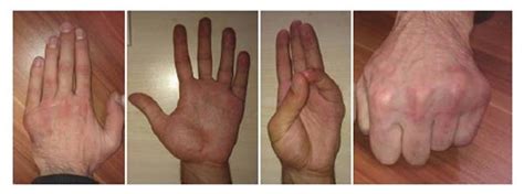 Metacarpophalangeal Joint Dislocation