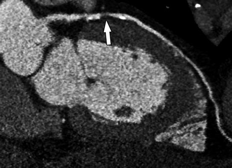 Coronary CT Versus MR Angiography Pro CTThe Role Of CT Angiography