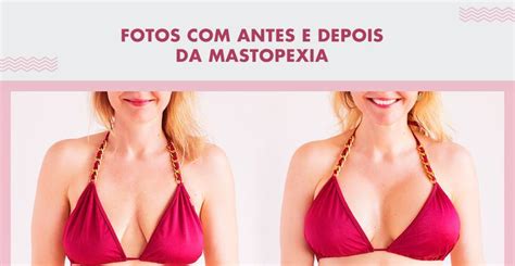 Mastopexia Antes e Depois fotos e dicas para você ter o resultado dos