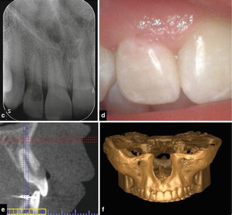 Root Resorption Pocket Dentistry