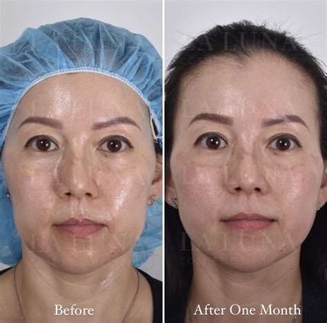Thread Lift Sydney 1 Cosmetic Doctors Face Neck Cheek Lift