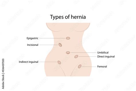 Types Of Hernia Epigastric Incisional Direct Inguinal Indirect