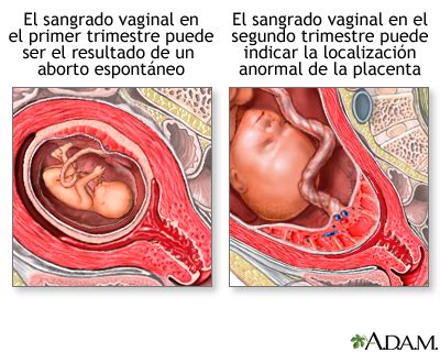 Sangrado vaginal durante el embarazo MedlinePlus enciclopedia médica