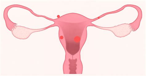 5 Puntos Clave A Tomar En Cuenta Si Tienes Fibromas Uterinos Y Debes