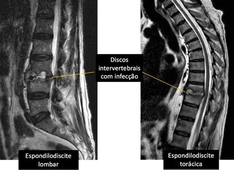 Espondilodiscite infecção na coluna vertebral Dr William Zarza