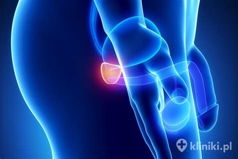 Nowoczesne Metody Leczenia Chor B Prostaty Kliniki Pl