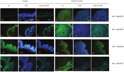 Immunofluorescence Analysis Of Keratins In Control And Lesional