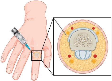 Guide To Local Anaesthetic Skintel