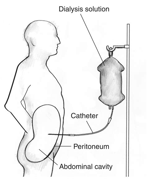 Patient Receiving Continuous Ambulatory Peritoneal Dialysis Media