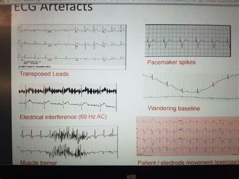 ecg artifacts movement electrodes muscle