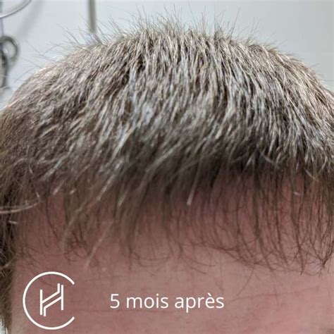 Greffe de cheveux évolution mois par mois 0 14 mois photos