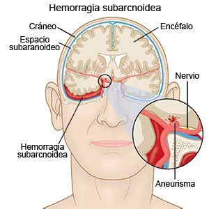 Hemorragia Subaracnoidea Care Guide Information En Espanol