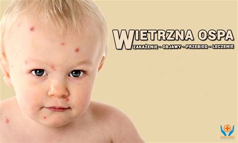 Ospa Wietrzna I P Pasiec Centrum Medyczne Przyja Ni