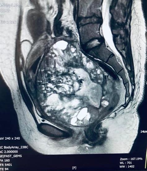Pent In Female Genital Tract Iranian Society Of Gynecology Oncology