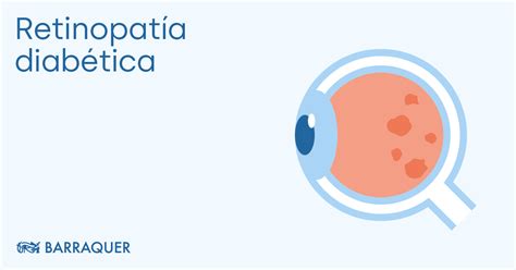 Retinopatía diabética Causas Síntomas y Tratamiento