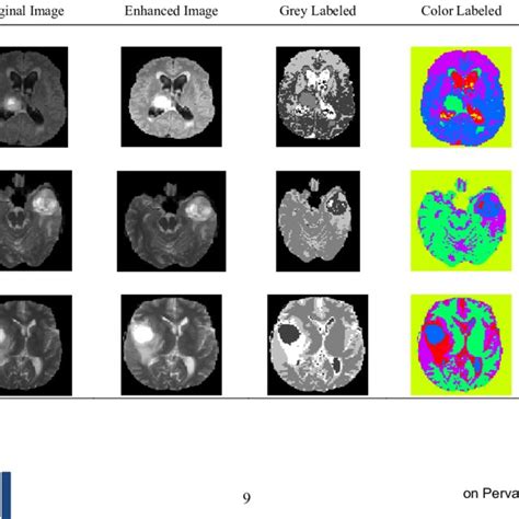 pdf enhanced brain tumour mri segmentation using k means with machine learning based pso and